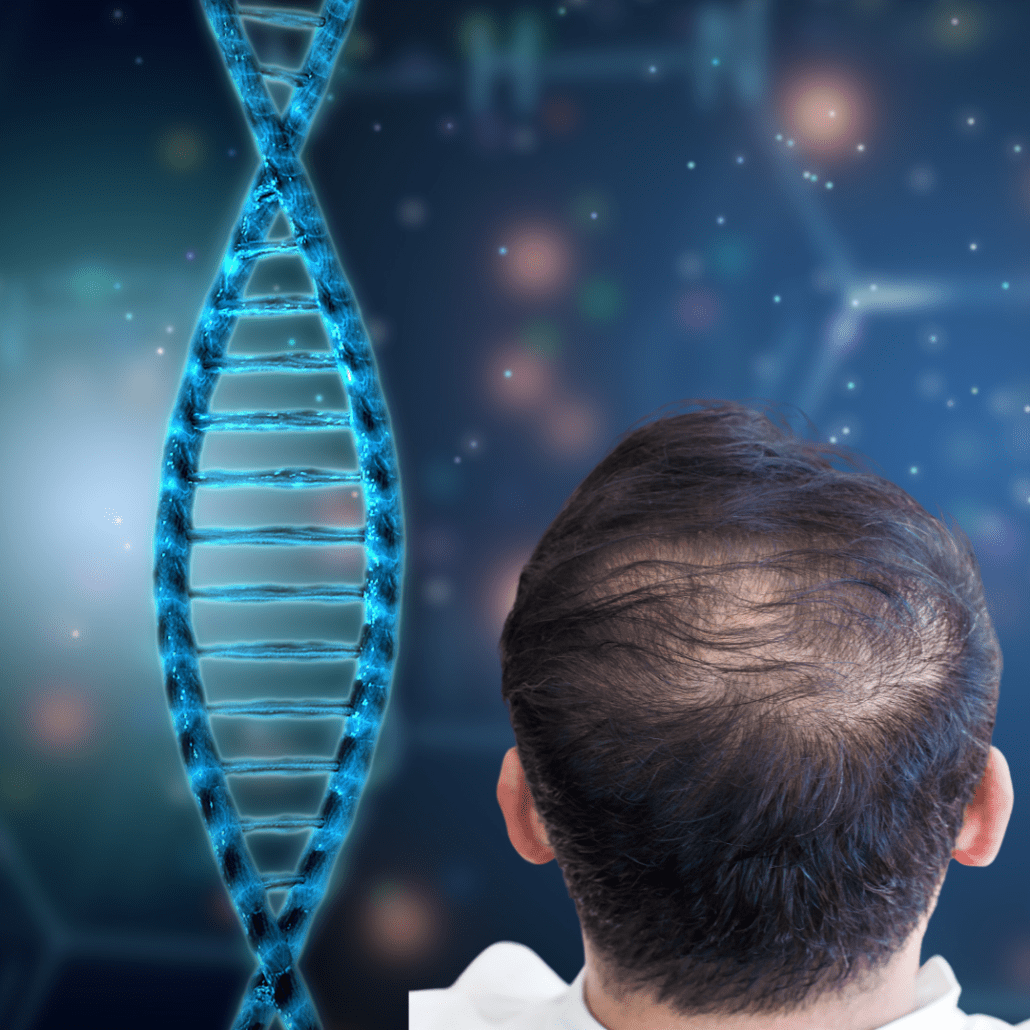 Male Pattern Hair Baldness Classification & Treatment | GeneHabit