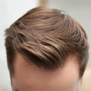 What is an M-shaped Hairline? Is it a sign of hair loss?