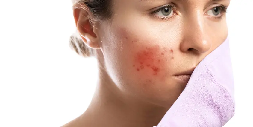 Best Facial Treatment for Acne