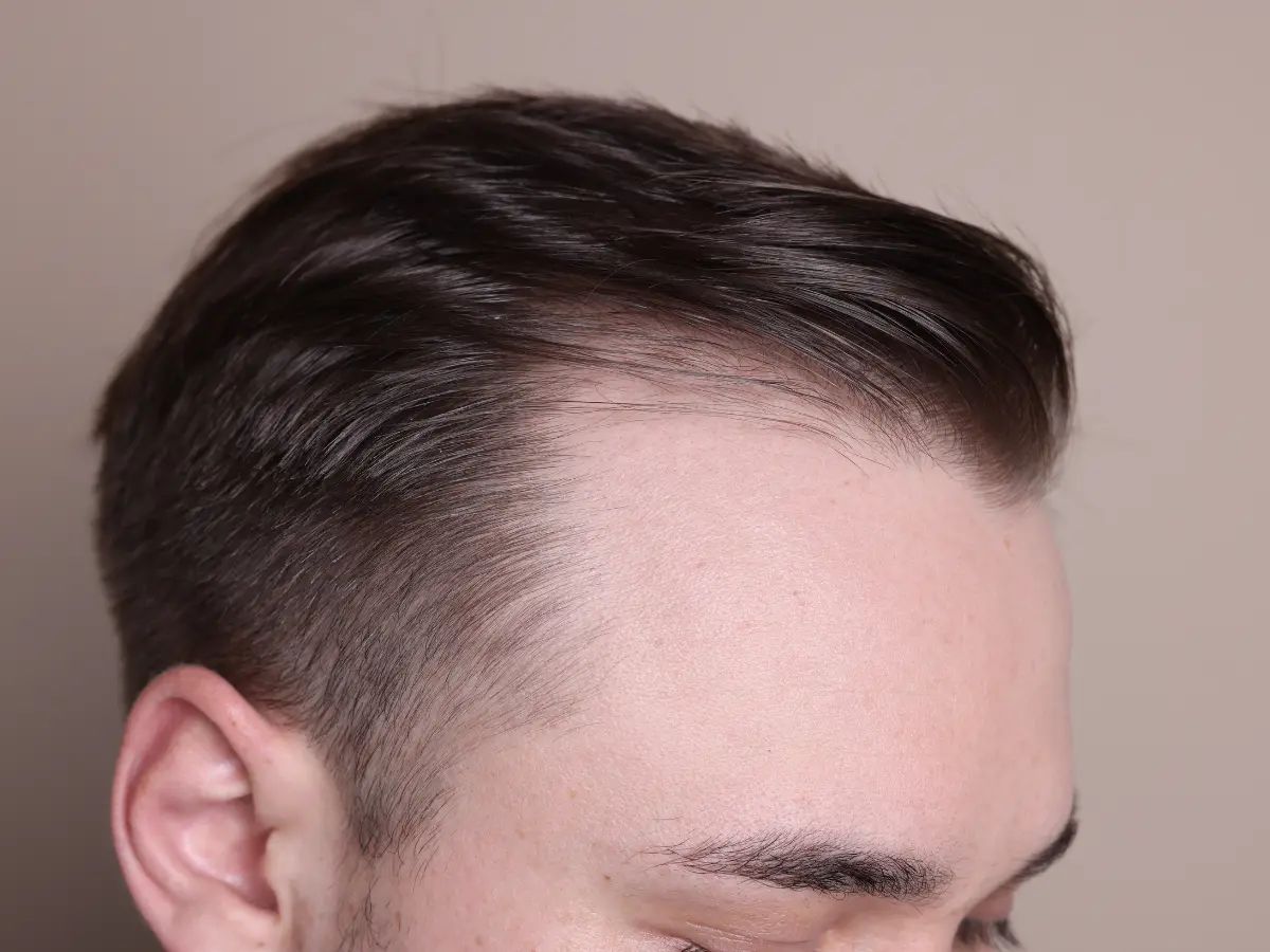 Science Behind Male Pattern Baldness: Role of Genetics